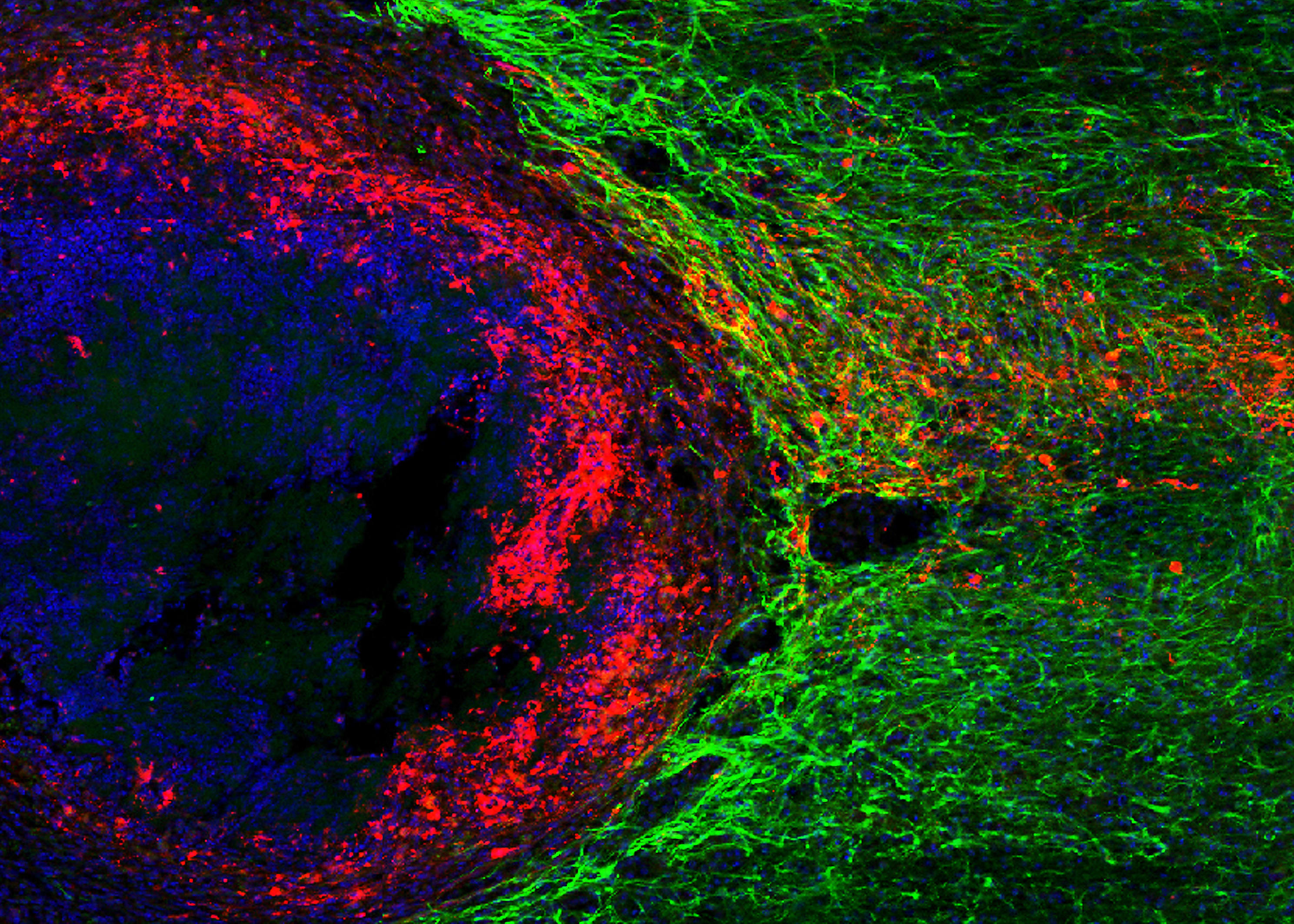 When single cell meets spatial, researchers uncover how people with ...